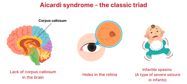 Aicardi syndrome - Rare Awareness Rare Education Portal